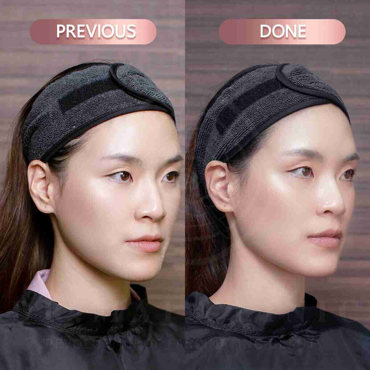 Filler ใต้ตา ร่องแก้ม ปาก คาง| ฟิลเลอร์แท้โดยแพทย์ DR.MAI CLINIC